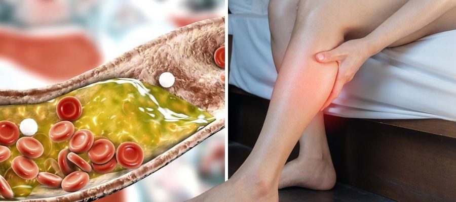 High cholesterol: The 'serious' signs in your legs that cholesterol has ...